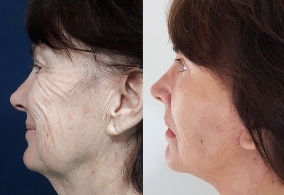Facelift Before and After #32 - CosMediTour Facelift Before and After #32 - CosMediTour