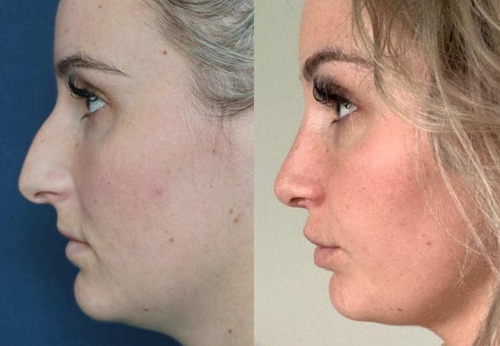 Before & After Rhinoplasty #82 - CosMediTour